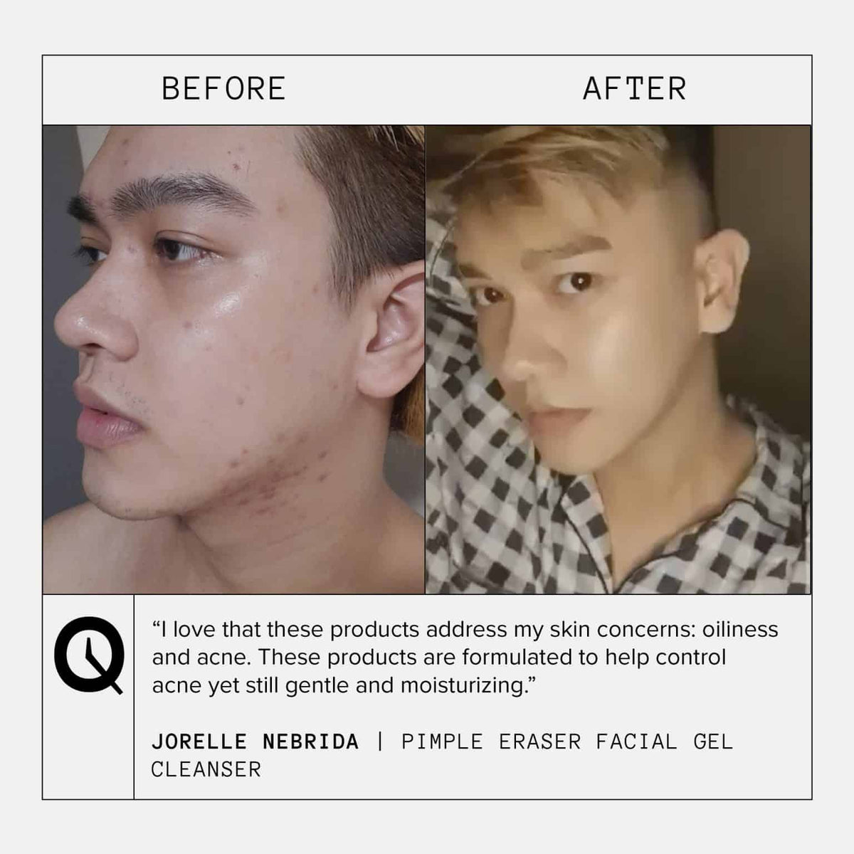 QUICKFX Pimple Eraser Facial Gel Cleanser – Dea's Kitchen and Pinoy ...
